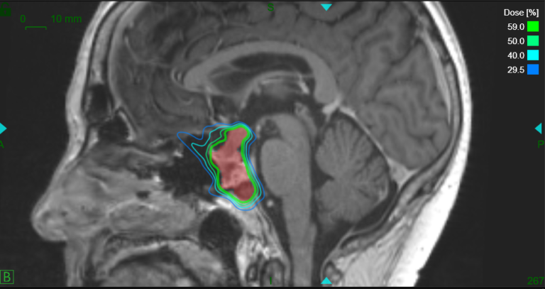 Hypophysenadenom - Swiss Neuro Radiosurgery Center