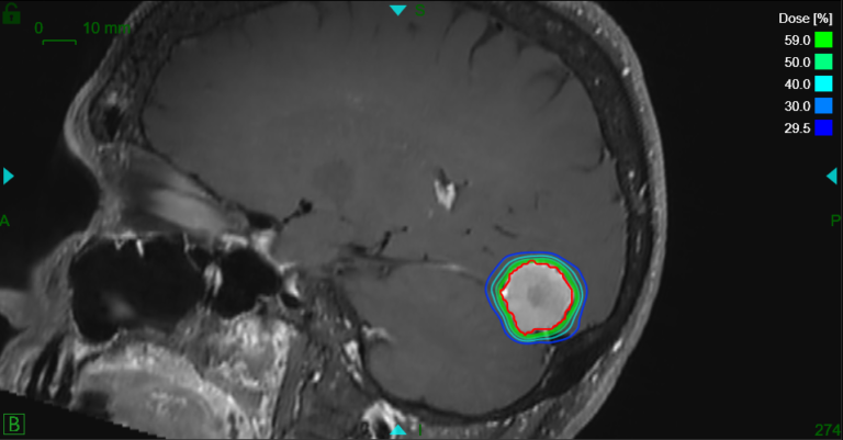 Meningeom - Swiss Neuro Radiosurgery Center